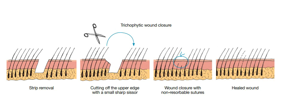 Hair Transplant - Otberg Medical